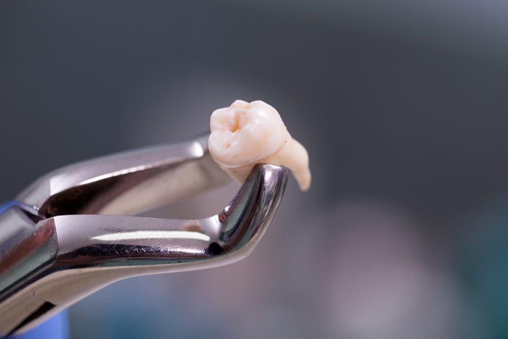 Dealing With A Dry Socket | Chattanooga Periodontics & Dental Implants, PC